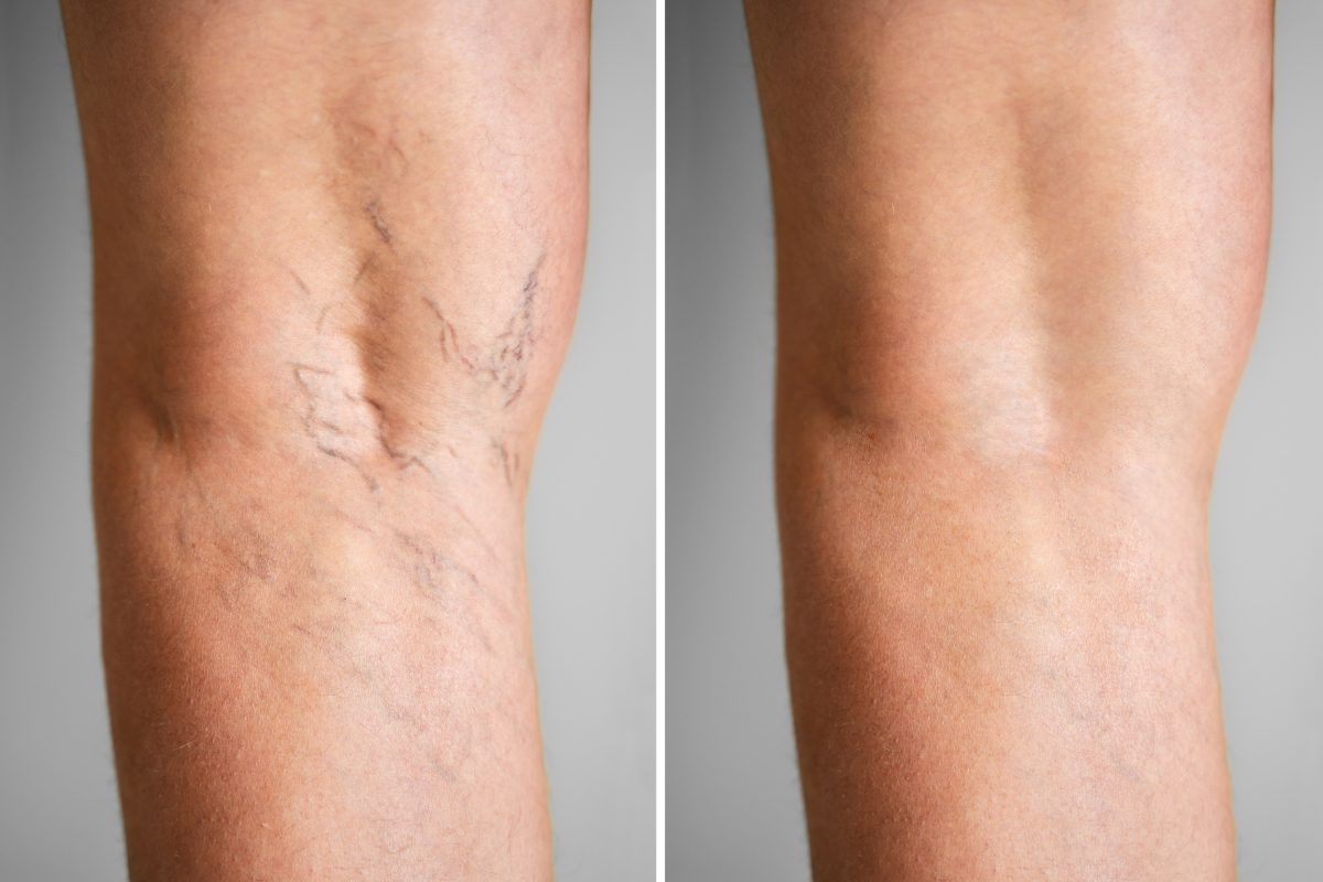 Revitalize Your Legs: California Veins Leading the Way in Varicose and ...