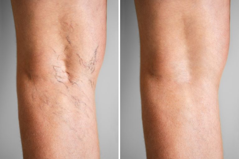 Understanding and Conquering Vein Disease: Comprehensive Care at ...